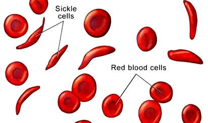 Children living with Sickle Cell Disease do live beyond age of 20 ...