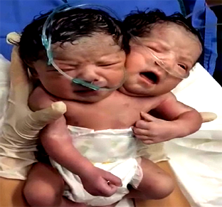 Conjoined twins share single body, two heads in Mexico - Vanguard News