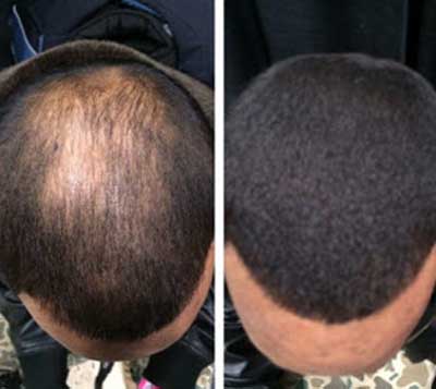 New Breakthrough Solution Leaves Men with Full Head of Hair, Reverse ...