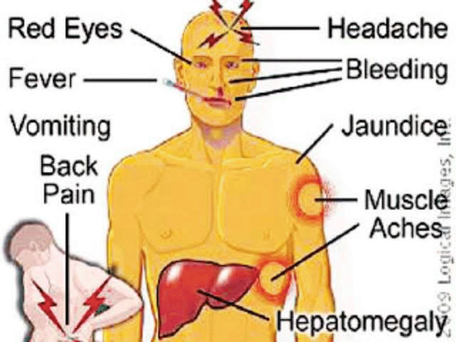 Finally, FG, WHO respond to Yellow Fever outbreak in Ebonyi - Vanguard News