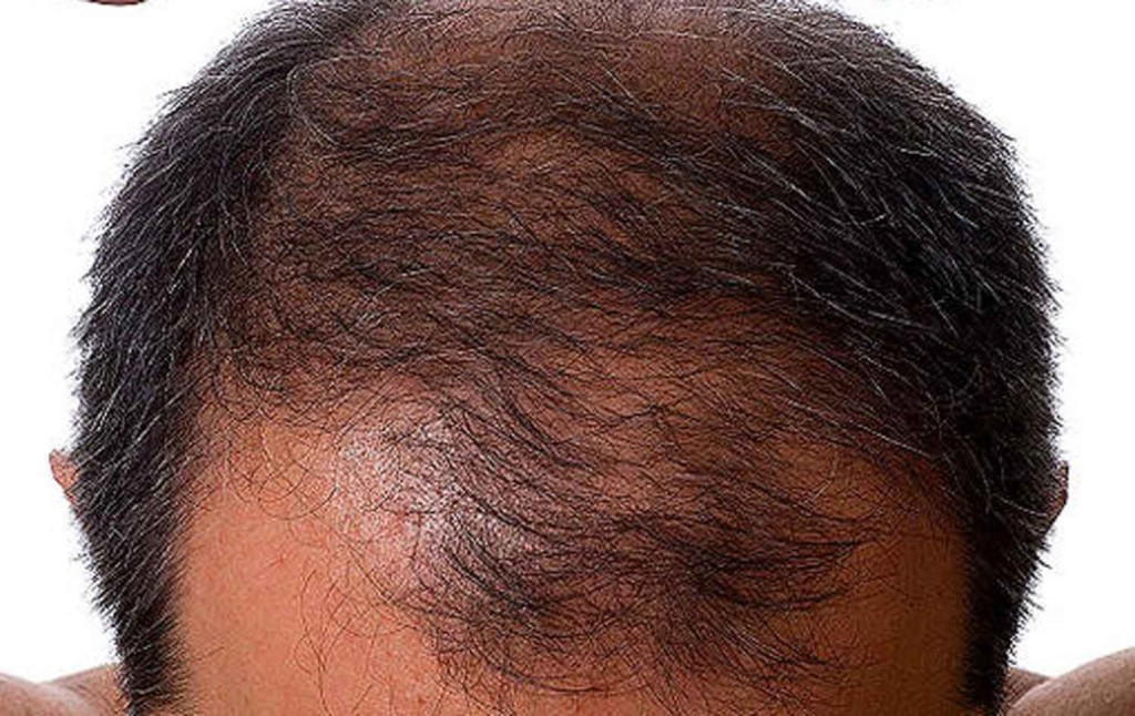 No one should suffer hair loss — VINCI - Vanguard News
