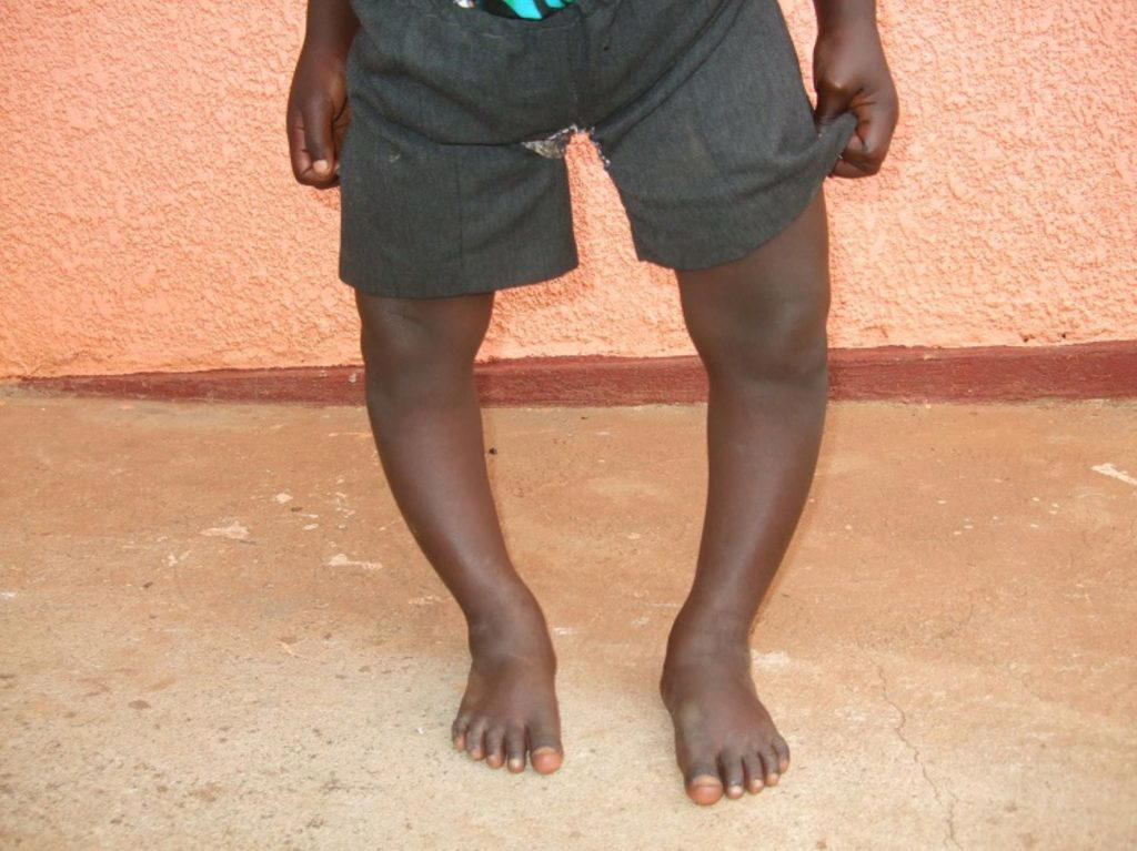 Bow legs: Expert recommends exposure to sunlight, healthy dieting...