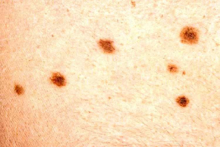 New study finds link between fish diet and skin cancer