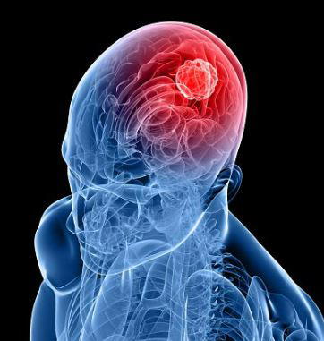 World-first treatment saves man from deadly brain cancer